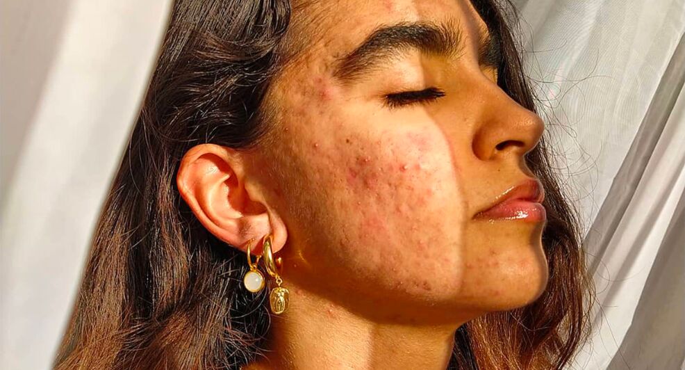 6 mythes over acné die je echt nooit moet geloven